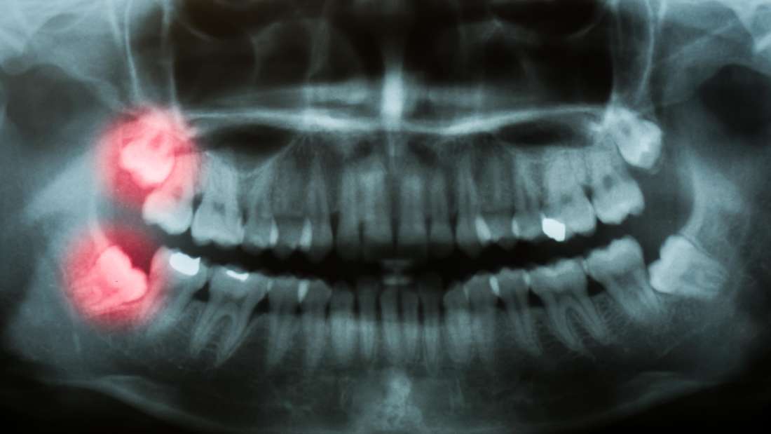 The Cost of Wisdom Teeth Removal | Tooth Extractions Allentown PA